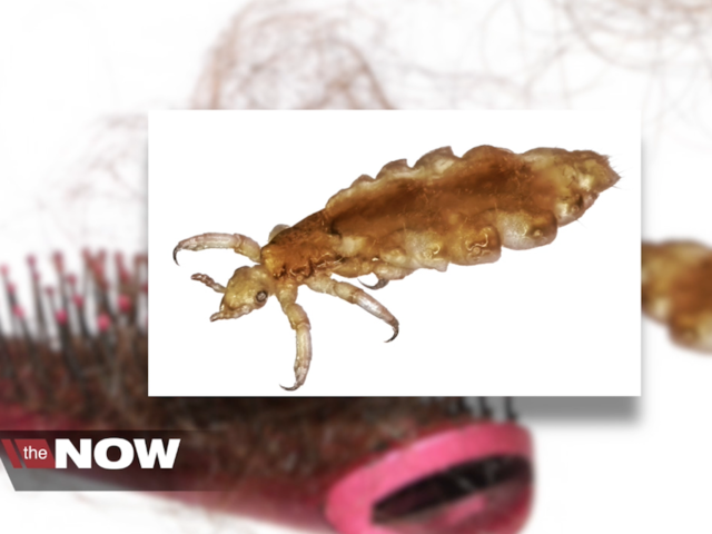 Study: 'Super lice' now exist in 48 states